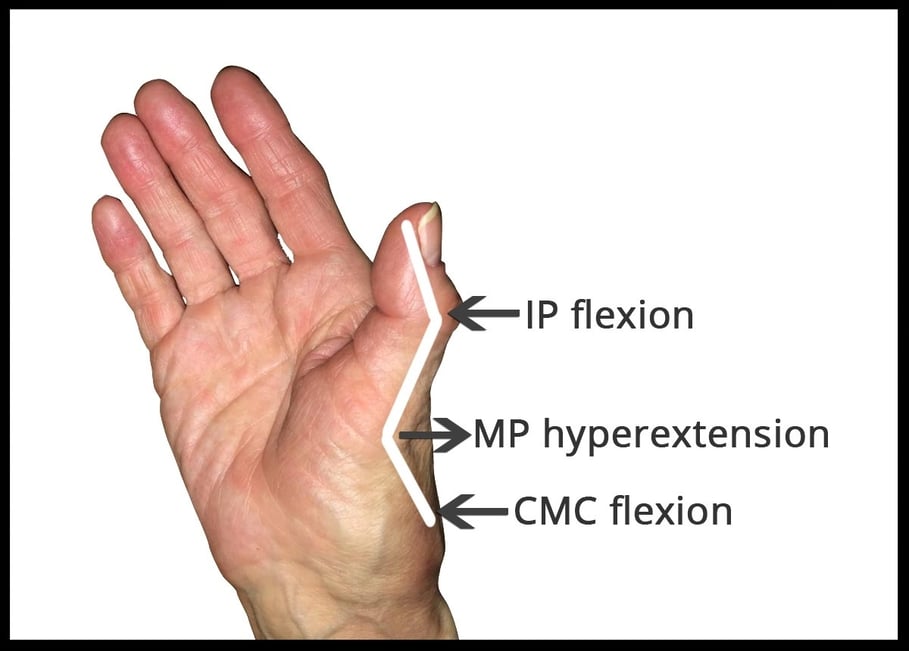 Treating CMC Joint Arthritis - Collapse Deformities of the Thumb Treating CMC Joint Arthritis - Collapse Deformities of the Thumb
